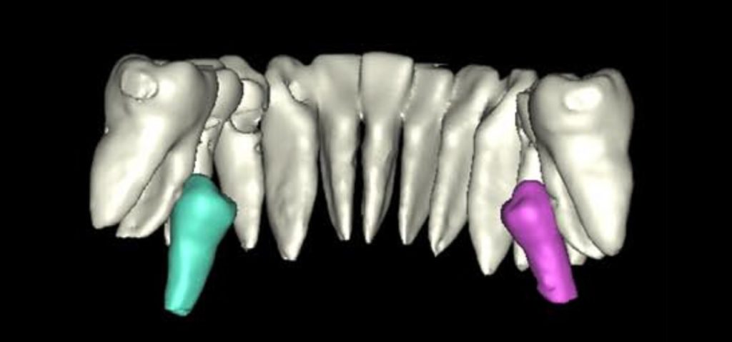 Dientes supernumerarios